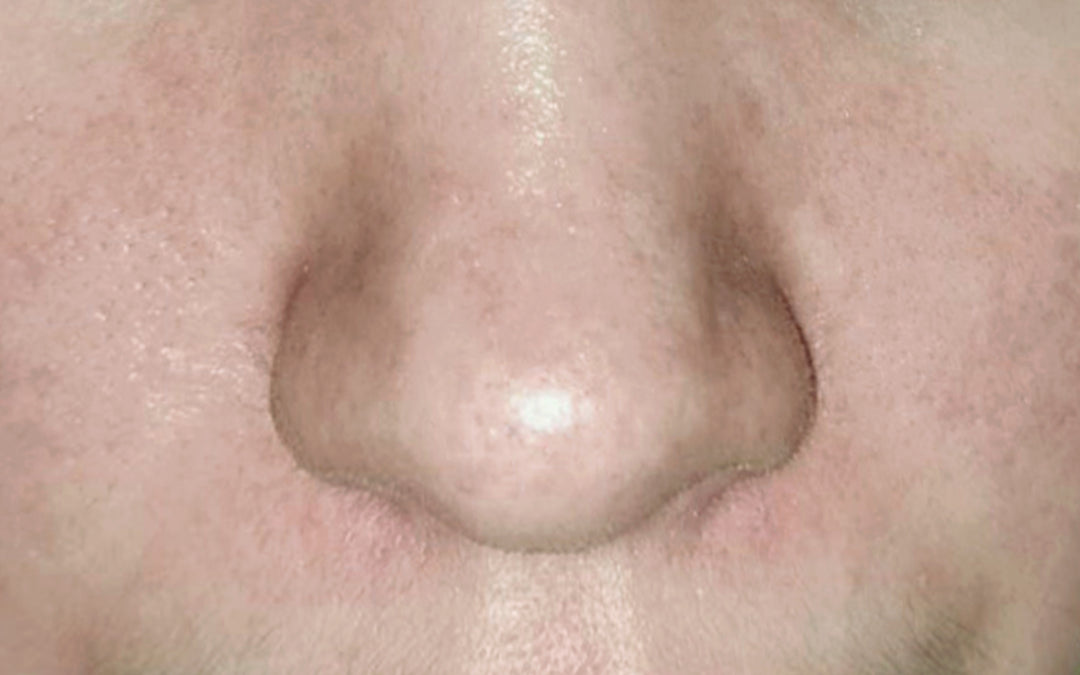 Acne Solution that Works – angels' skin®